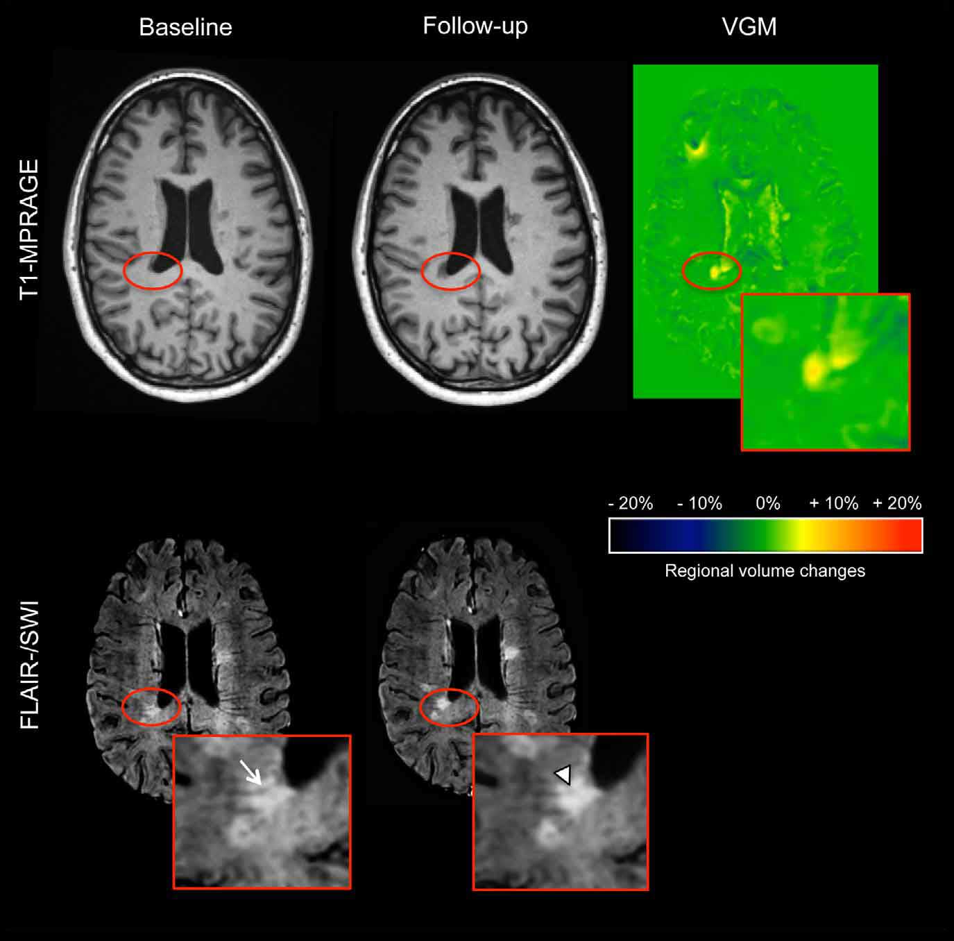 VGMorph 2026 | Voxel-guided morphometry